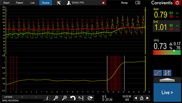 Information About Coroventis CoroFlow | Abbott
