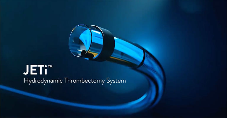 JETi Hydrodynamic Thrombectomy System | Abbott