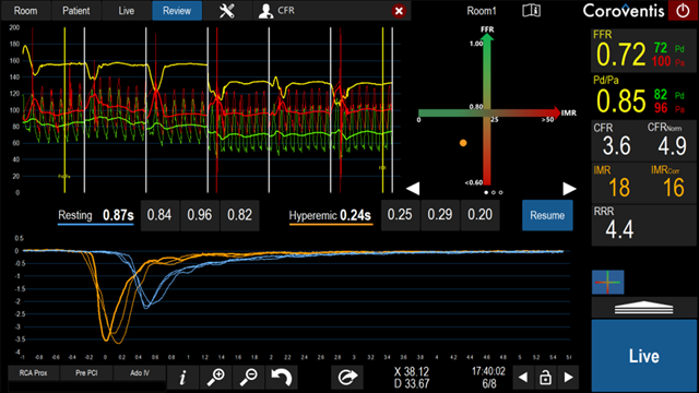 機能について | CoroFlow‡ Cardiovascular System | 冠内圧測定システム | アボットメディカルジャパン合同会社