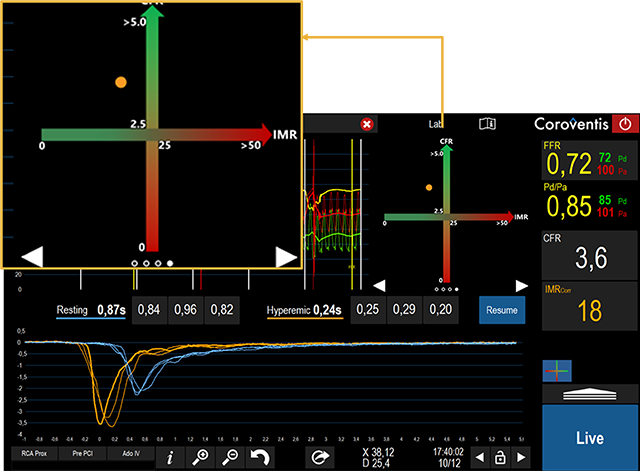 機能について | CoroFlow‡ Cardiovascular System | 冠内圧測定システム | アボットメディカルジャパン合同会社