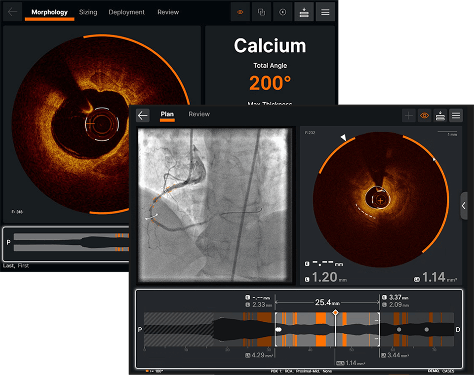 Ultreon™ Software for OCT Intravascular Imaging | Abbott