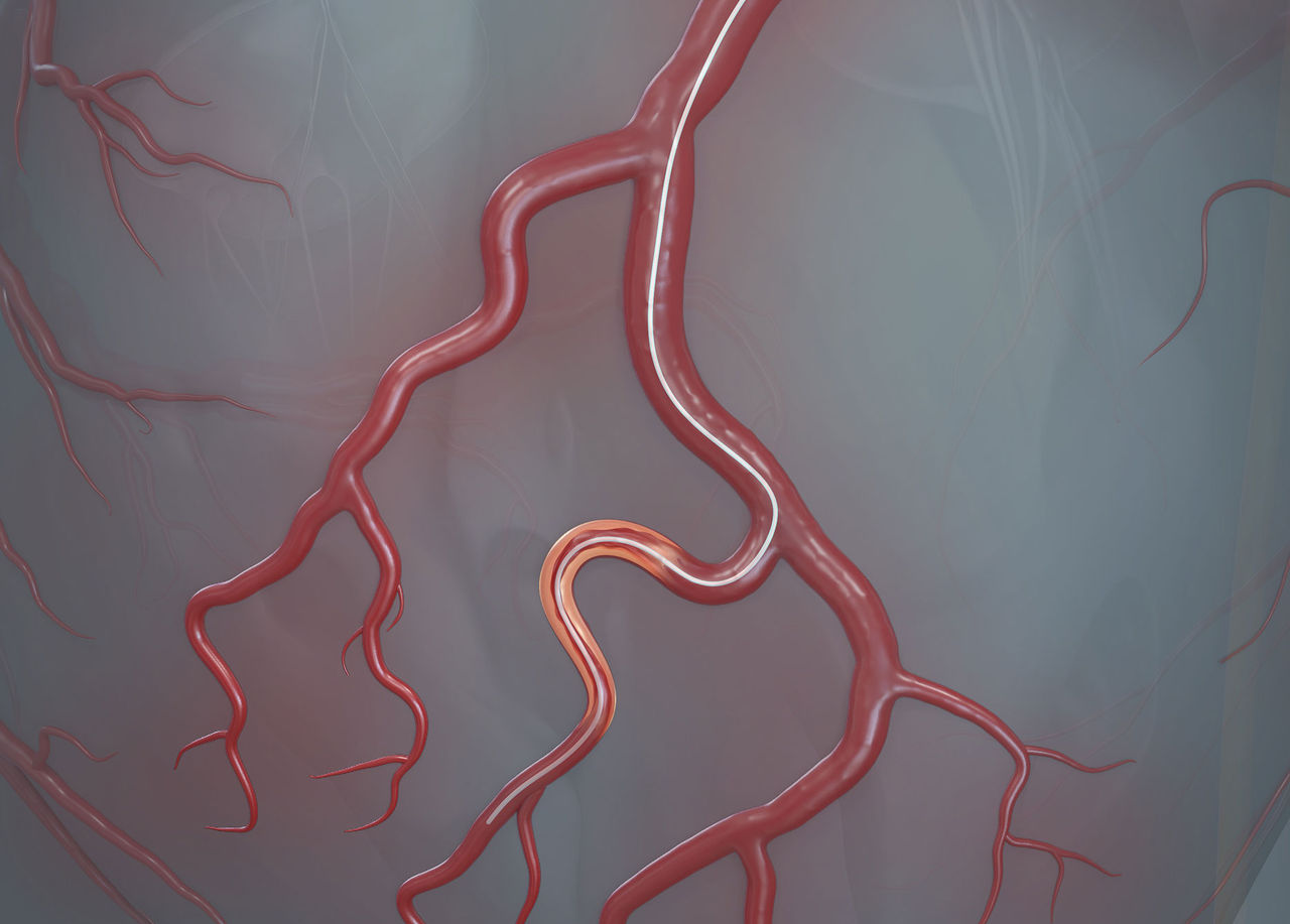 Clinical Examples for Coronary Specialty Guide Wires | Abbott