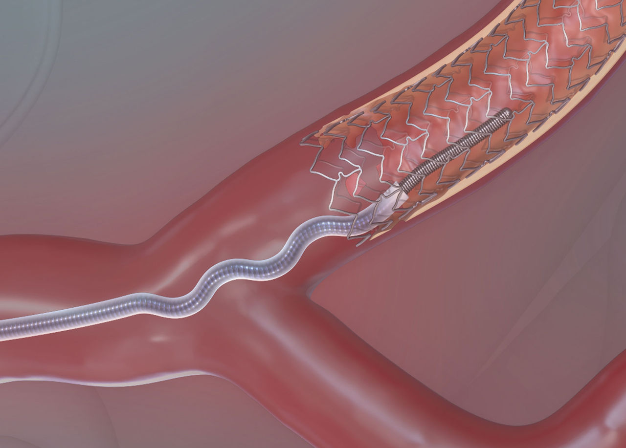 Clinical Examples for Coronary Specialty Guide Wires | Abbott
