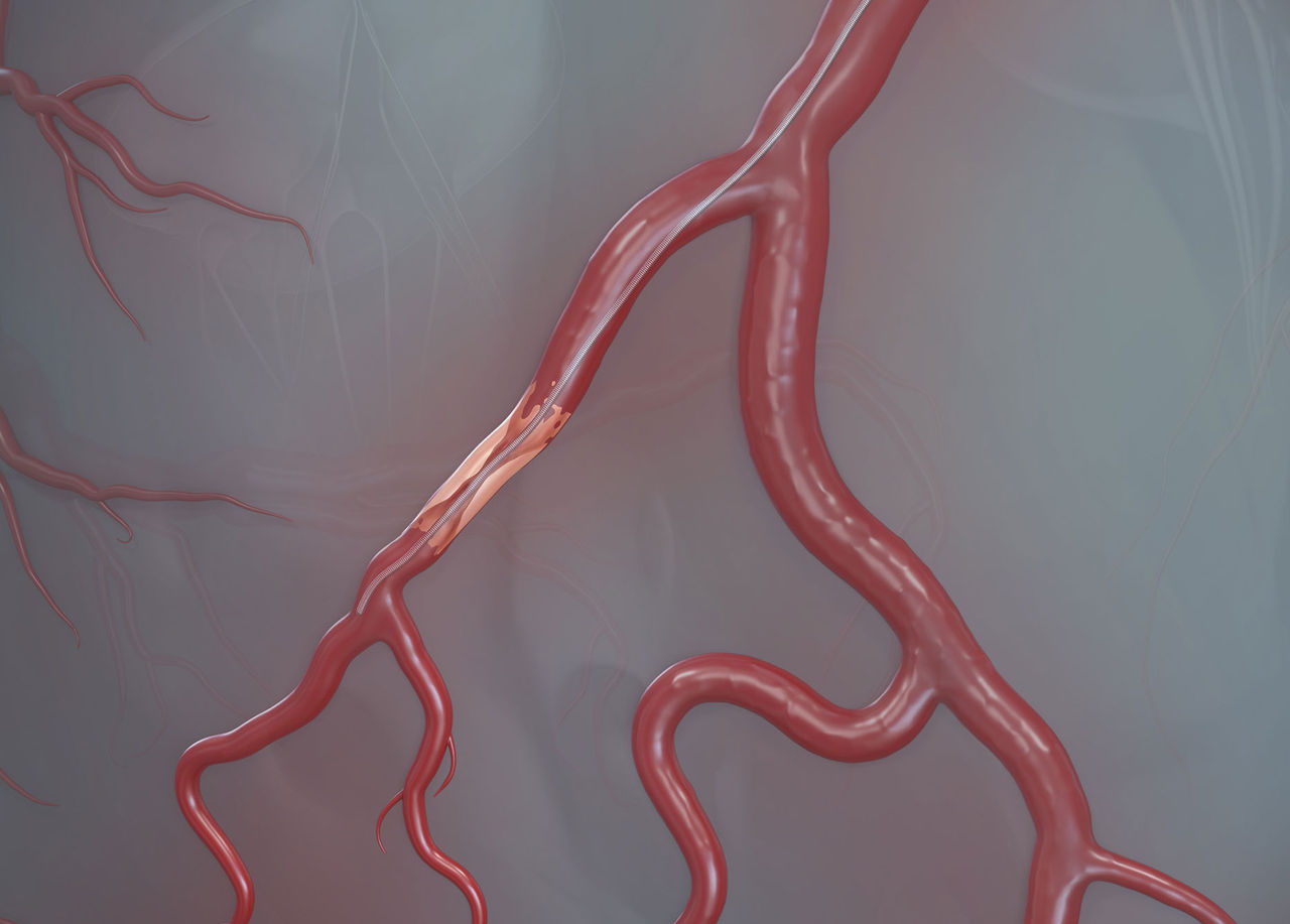 Clinical Examples for Coronary Specialty Guide Wires | Abbott