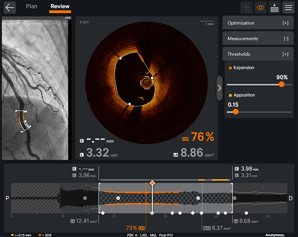 Intravascular Imaging Optical Coherence Tomography (OCT) LightLab ...